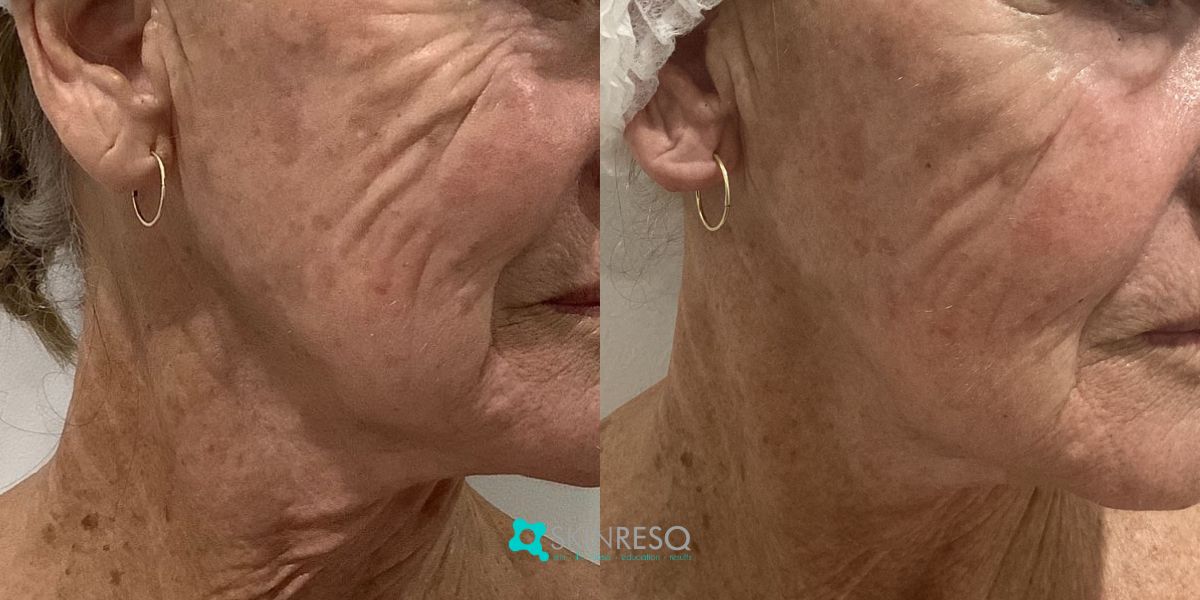 Tixel Skin Tightening – Skin ResQ Perth